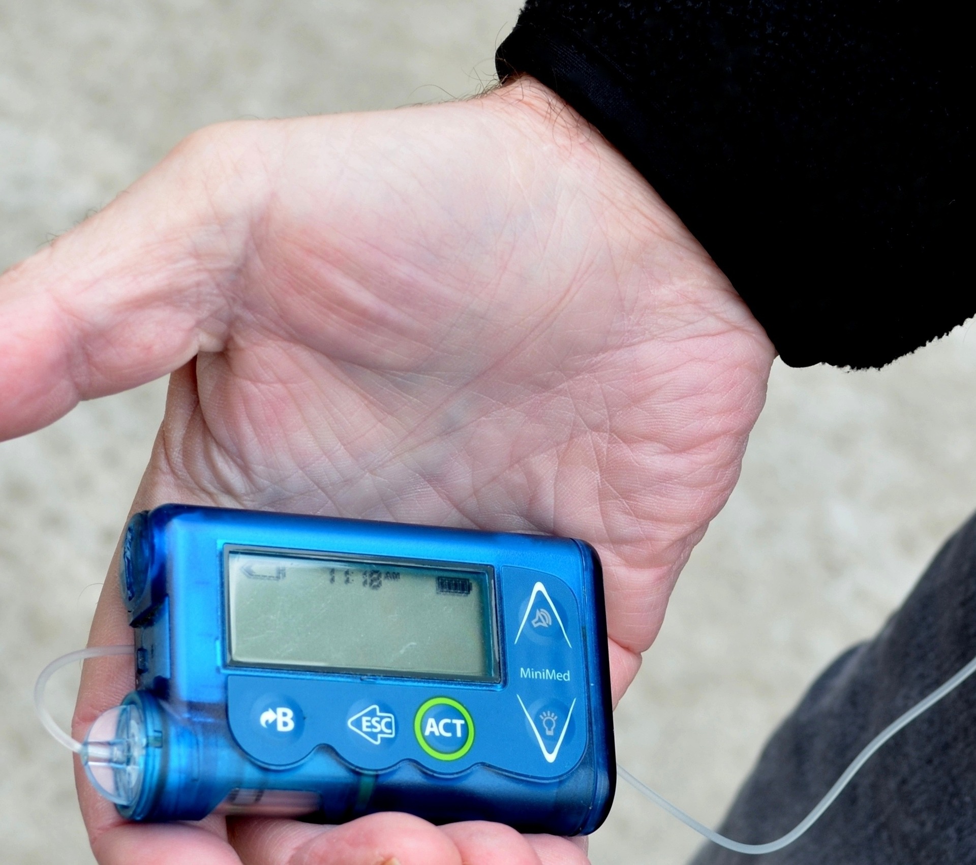 Insulin Pumps – Diabetes Roadmap